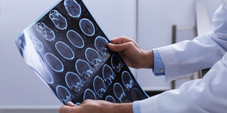 Current management of secondary progressive multiple...